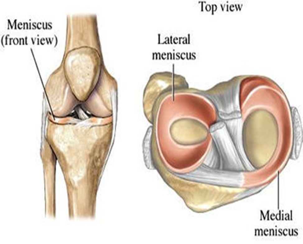 Meniscal Tears Brisbane Knee And Shoulder Clinic Dr